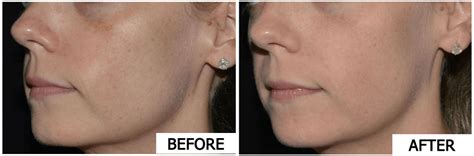 Lutronic LaseMD Ultra Laser Dallas Dermatology And Aesthetics