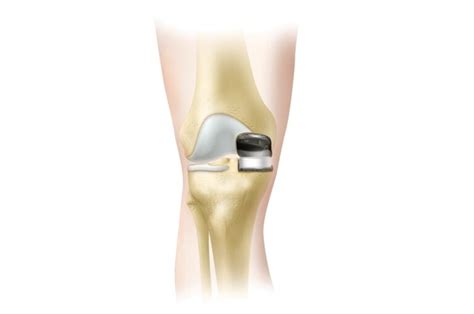 How Much Time Will I Have To Be Off Work For Knee Replacement Surgery