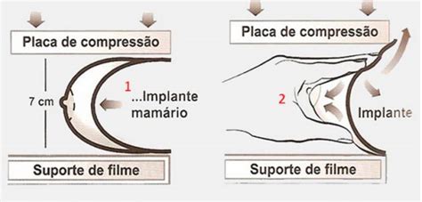 Meus Lindos E Pagos Arquivos Quem Tem Prótese De Silicone Pode