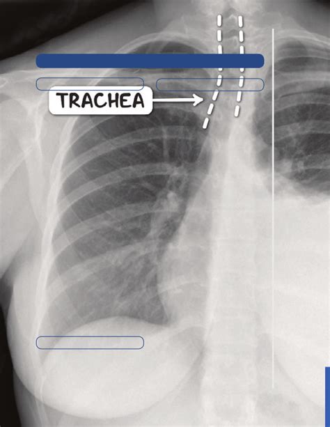 Pneumothorax Osmosis