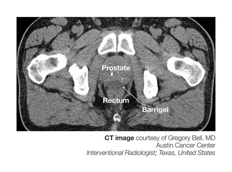 Barrigel® Rectal Spacing