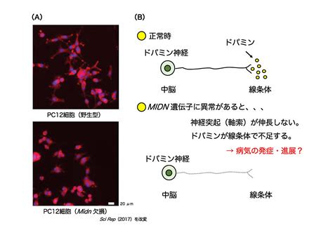 パーキンソン病とmidnの関連性の研究｜国立大学法人 山形大学