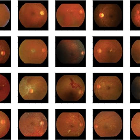 Some Fundus Photography Images From The Aptos Dataset For Diabetic Download Scientific Diagram