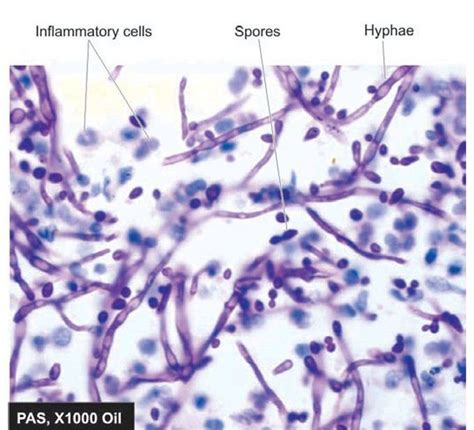 Candidiasis Medizzy