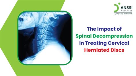 The Impact Of Spinal Decompression In Treating Cervical Herniated Discs