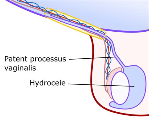 Hydrocele Scrotal Lump Geeky Medics