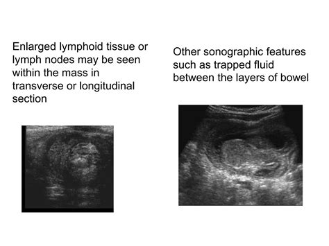 Intussusception Pptx Digestive Disorders Diseases And Conditions