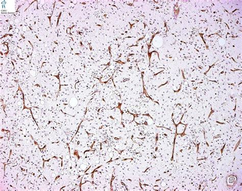 Myxoid Liposarcoma Of Soft Tissue Humpath Human Pathology