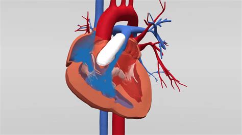 About Pulmonary Artery Reconstruction Treatment Stanford Medicine