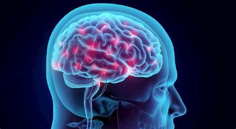What Is Post Concussion Syndrome