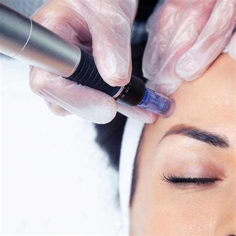 Mezoterapia mikroigłowa Beauty Park