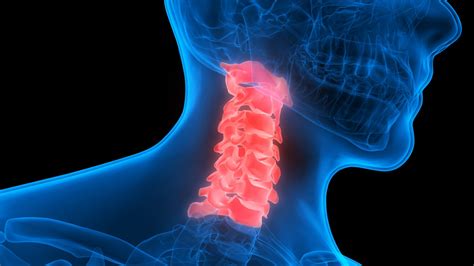 Cervical Disc Degeneration