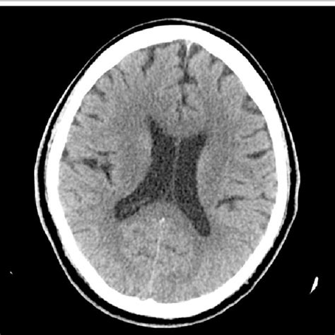 Repeat Ct Head For Confusion In Case 2 Showing Mild Parenchymal Volume