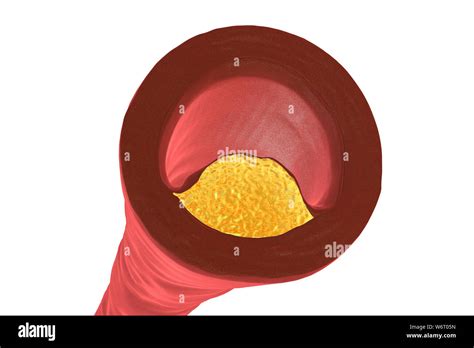 Atheromatous Plaque Inside Blood Vessel Computer Illustration A Cholesterol Atheroma Is