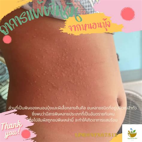 อาการแพ้ผื่นคัน จากหนอนบุ้ง ใช้ยาทาอะไร แกลเลอรีที่โพสต์โดย สมุนไ