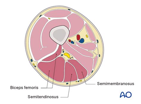 Compartment Syndrome In The Thigh