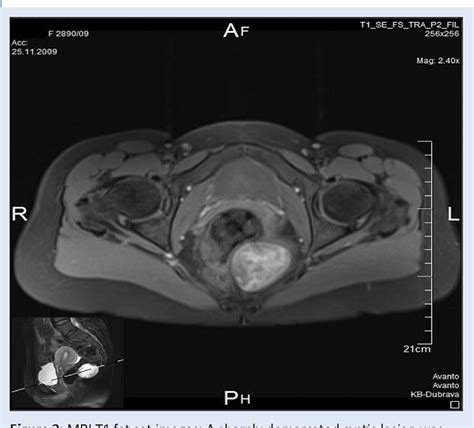 Figure 4 From Epidermoid Cyst In Presacral Space Epidermoidna Cista