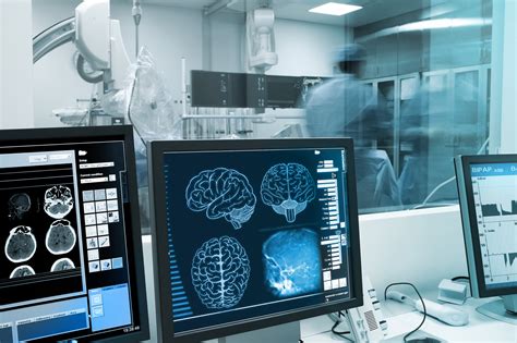 Brain Avm Embolization
