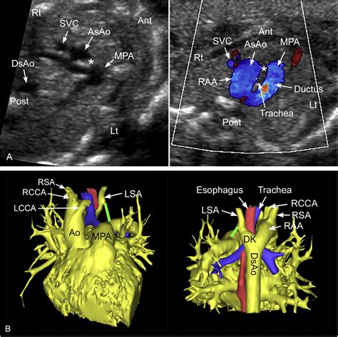 Prenatal Diagnosis Of Vascular Ring Evaluation Of Fetal Diagnosis And