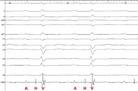His Bundle Electrogram Mapping Approach With The 12 Lead Ecg And