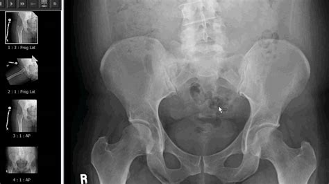 Normal Hip Xray Review Steamtaste