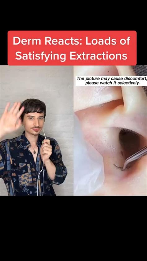 Derm Reacts Loads Of Satisfying Extractions Zit Popping Videos Derm