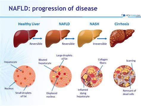 Multiparametric Diagnosis Of Fatty Liver Disease With Magnetic