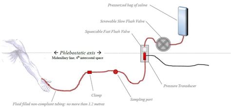 How To Zero A Cvp Line 11 Pages Summary 16mb Updated 2021 Ace
