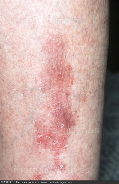 Stock Image Dermatology Psoriasis Dry Pink Patches With Some White