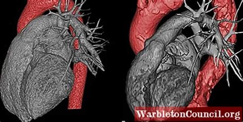 Elongated Aorta Causes Risks And Treatments Science
