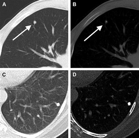 Imaging The Solitary Pulmonary Nodule Clinics In Chest Medicine