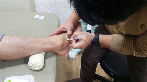 Sinus Tarsi Injection