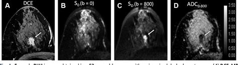 Figure 1 From Multiparametric Mr Imaging Of Breast Cancer Semantic