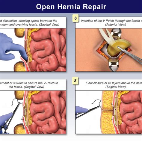 Vertebral Dissection Trial Exhibits Inc