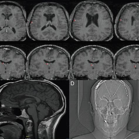 Pdf Responsive Neurostimulation Targeting Anterior Thalamic Nucleus In Generalized Epilepsy