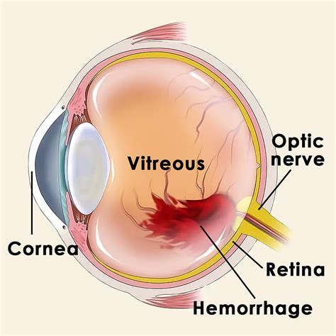 Vitreous Hemorrhage Diagnosis And Treatment