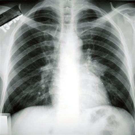 Chest X Ray On Admission Showing A Mass Shadow Superposing On The Left Download Scientific