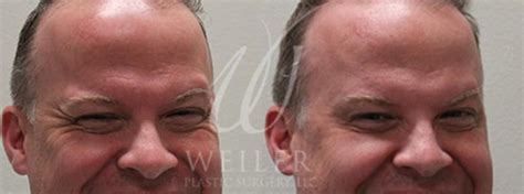 Botox® Cosmetic Before And After Pictures Case 13 Baton Rouge New