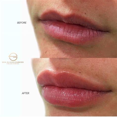 Labios Inflamados Despues De Acido Hialuronico Labios Tatuados Letra