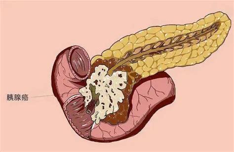 胰腺癌扩散就没办法治疗了吗？4种提高预后的治疗方法 知乎