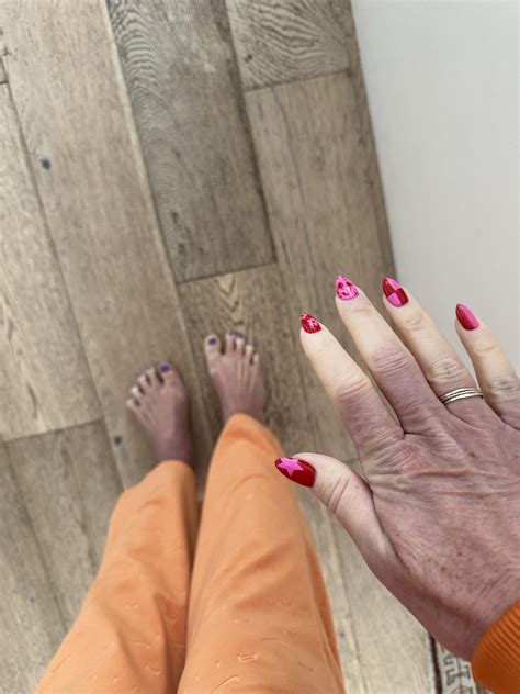 This Is What Limited Scleroderma Looks Like R Scleroderma