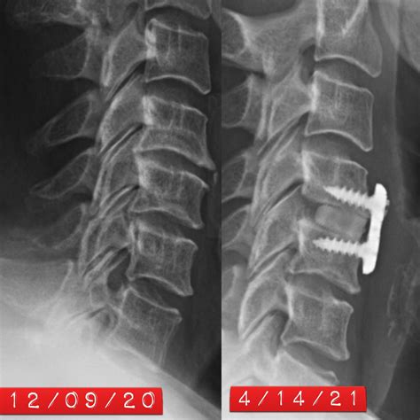 Acdf C3 C4 Album On Imgur