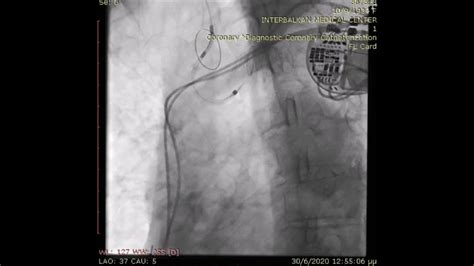 Implanting Sentinel Embolic Protection Device In Bovine Aortic Arch