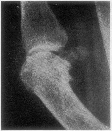 Case 1 Oblique View Of Right First Metacarpal Head Showing Probabk