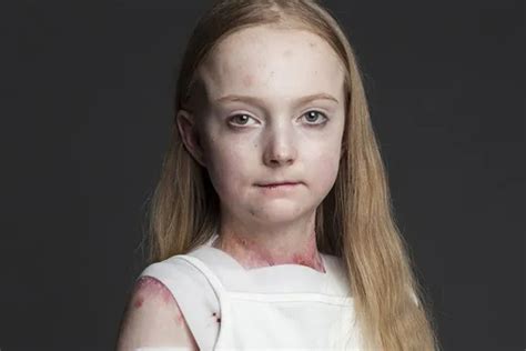 علت بیماری پروانه ‌ای کودکان چیست و چگونه به وجود می‌ آید؟