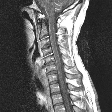 Clinical Images A Rare Case Of Cryptococcal Meningoencephalitis In An