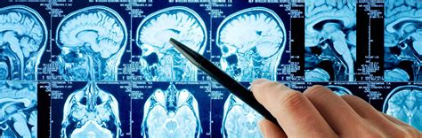 Estimulação Cerebral Profunda Marcapasso Cerebral