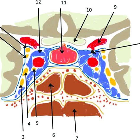 Cta Head Consistent With Invasive Fungal Sinusitis Involving The Right