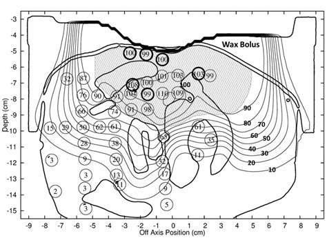 Measured TLD Doses N 46 For The Retromolar Trigone Phantom With
