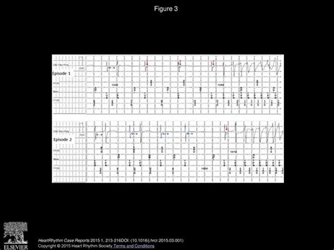 Early Repolarization Syndrome A Case Report Focusing On Dynamic